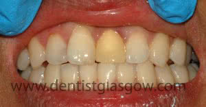 Single Central Incisor Crown Case Study | Appletree Dentist Glasgow