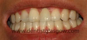 Single Central Incisor Crown Case Study | Appletree Dentist Glasgow