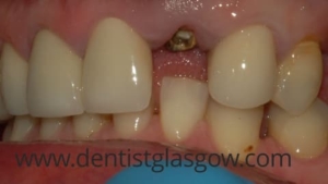 Fractured Root: New Porcelain Crown to Replace Old One